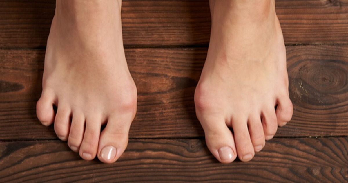 Jak vzniká vbočený palec a jak ho léčit? Příčiny, prevence a léčba ...