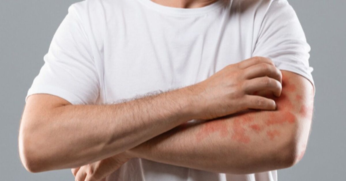 Hlavní příčiny atopického ekzému | Klinika komplexní péče